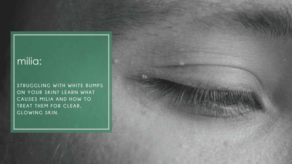 Milia Explained - Skin Deep Esthetics LLC